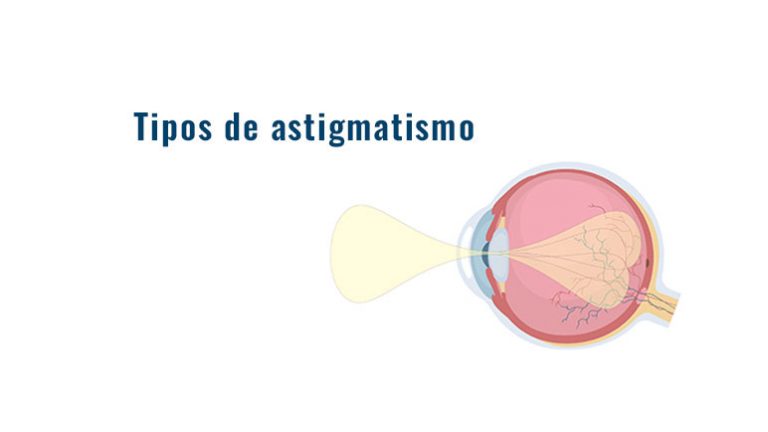 Tipos de astigmatismo