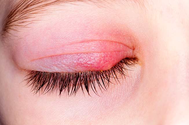 Tratamento de blefarite e disfunção glândulas de Meibómio