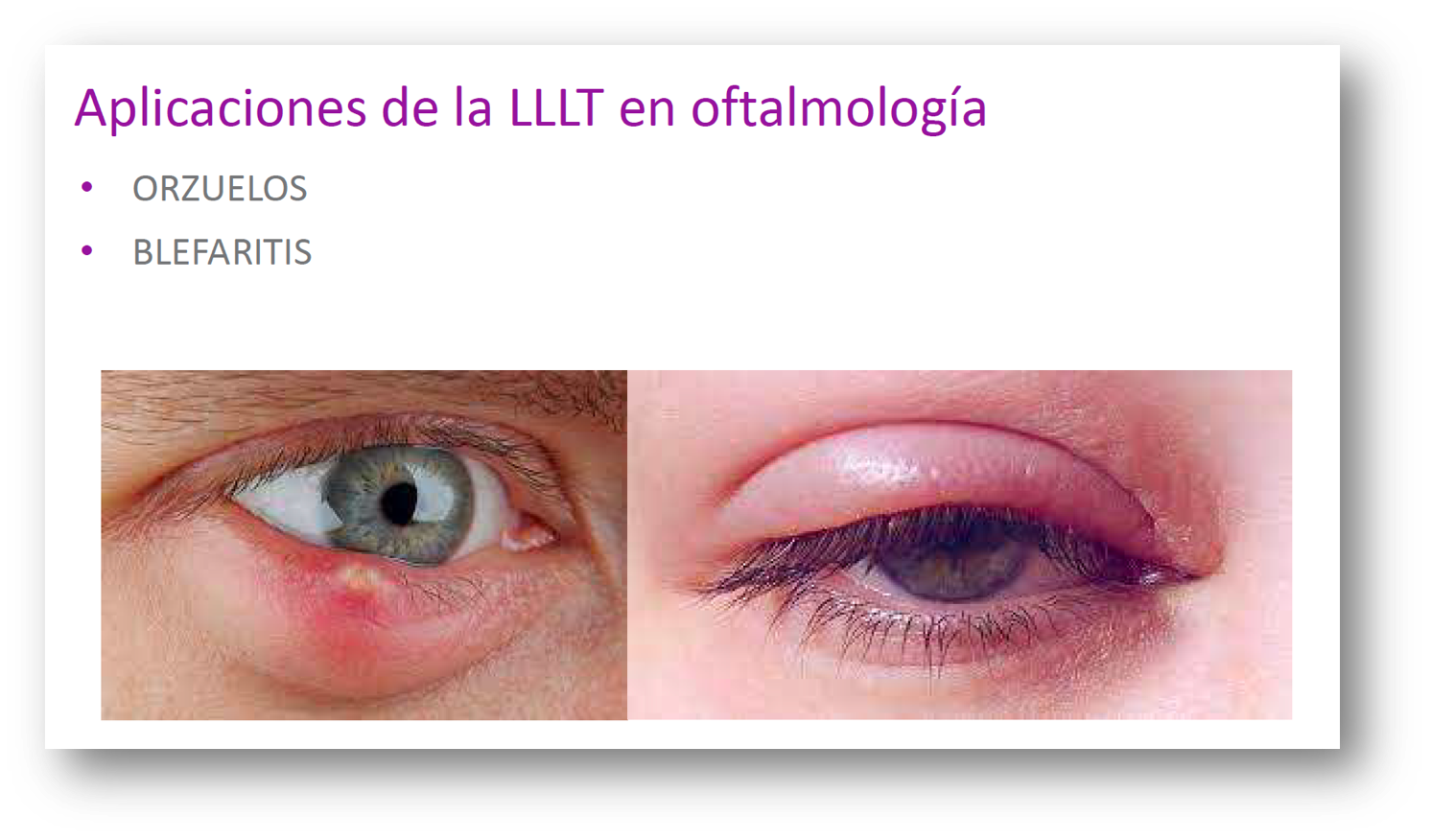 Novedoso tratamiento para chalazión, orzuelo y blefaritis crónica y ...
